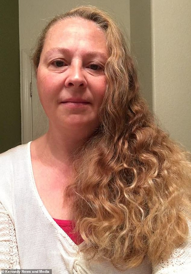 Heppin að vera á lífi eftir að hafa fallið ofan í varðeld: „Eldurinn ...