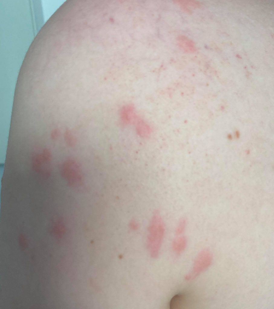 Lúsmýið líklega verst í Hveragerði: Hrikaleg bitsár - DV