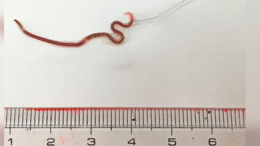 Fundu orm í hálsi konu - DV