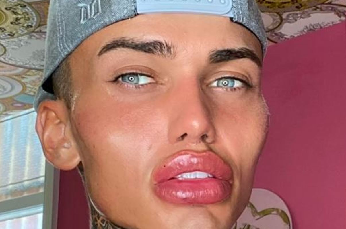 Sjáðu fyrir og eftir myndirnar: Áhrifavaldurinn sem vildi líkjast ...